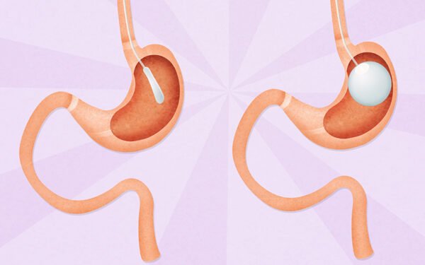 The Ultimate Guide to Gastric Balloon - Today World Info The Ultimate Guide to Gastric Balloon - Today World Info